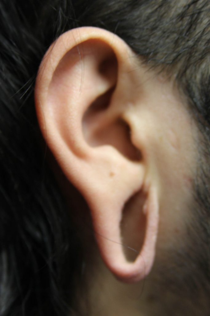 Gauged earlobe treatment may be easier than you think